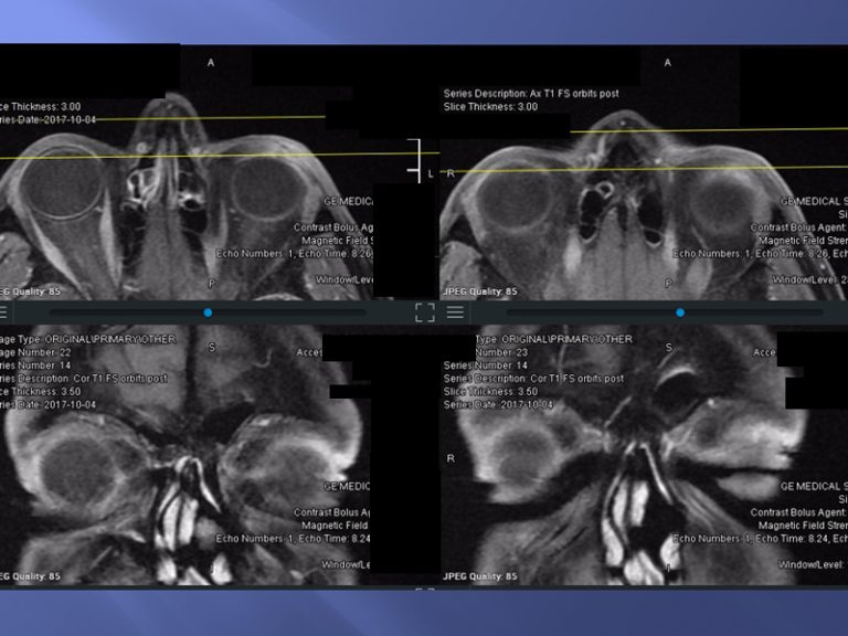 Twice Recurrent Upper Eyelid Scc Skin Cancer And Reconstructive