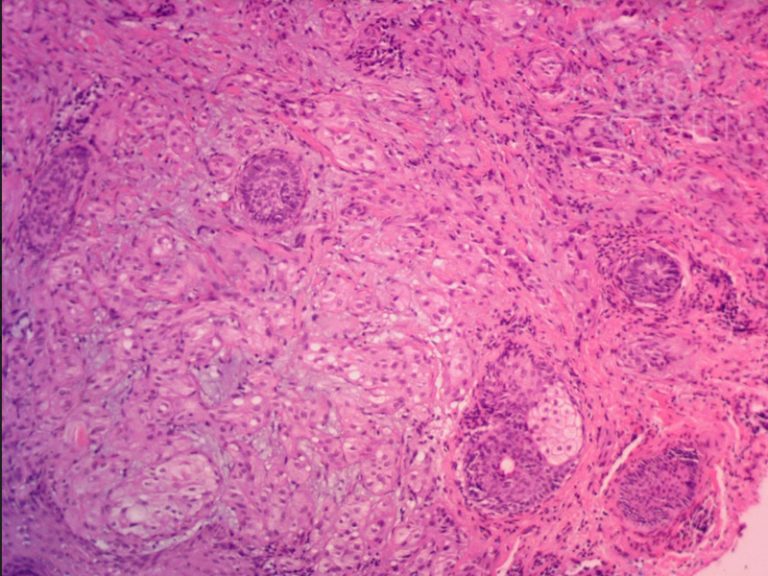 Twice Recurrent Upper Eyelid SCC - Skin Cancer and Reconstructive ...