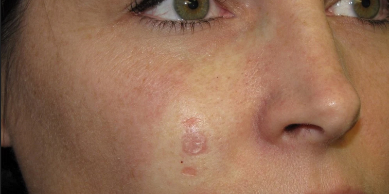 blogs - Skin Cancer and Reconstructive Surgery Center