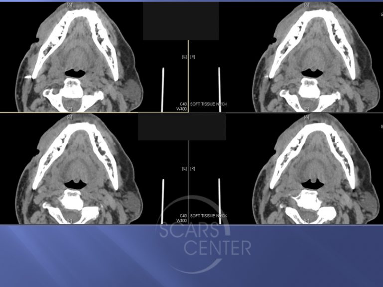 FIELD CANCERIZATION WITH BASAL CELL CARCINOMA - Skin Cancer and ...