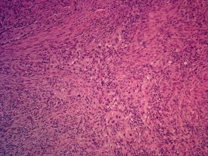 Deeply Invasive Squamous Cell Carcinoma of Cheek - Skin Cancer and ...