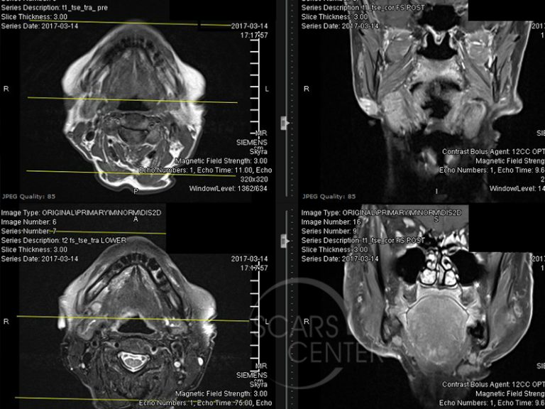 INVASIVE BOWEN'S CARCINOMA OF CHEEK - Skin Cancer and Reconstructive ...
