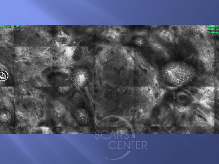 MAPPING OF BCC WITH CONFOCAL MICROSCOPY - Skin Cancer and ...