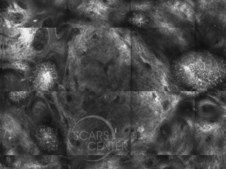MAPPING OF BCC WITH CONFOCAL MICROSCOPY - Skin Cancer and ...