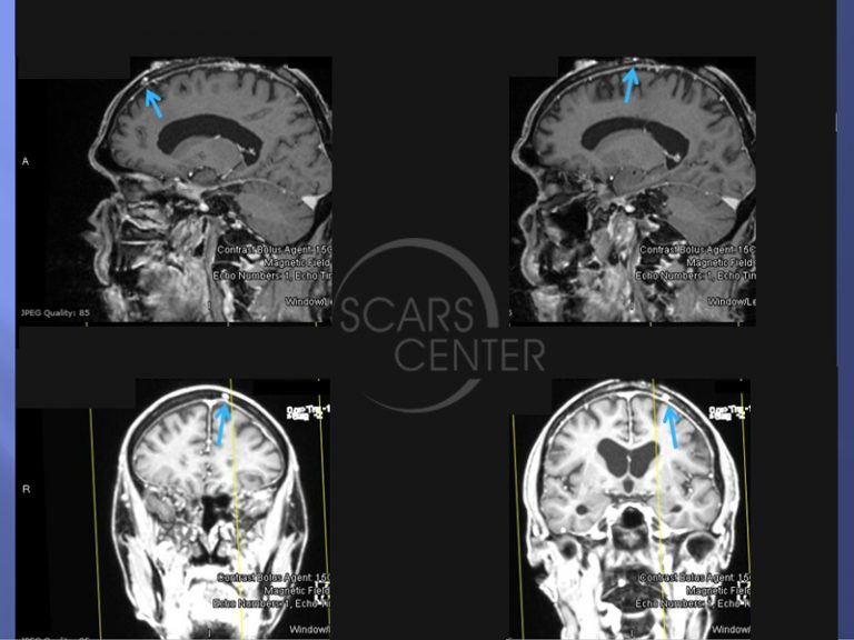 RECURRENT SCALP MELANOMA WITH CALVARIAL METASTASES - Skin Cancer and ...