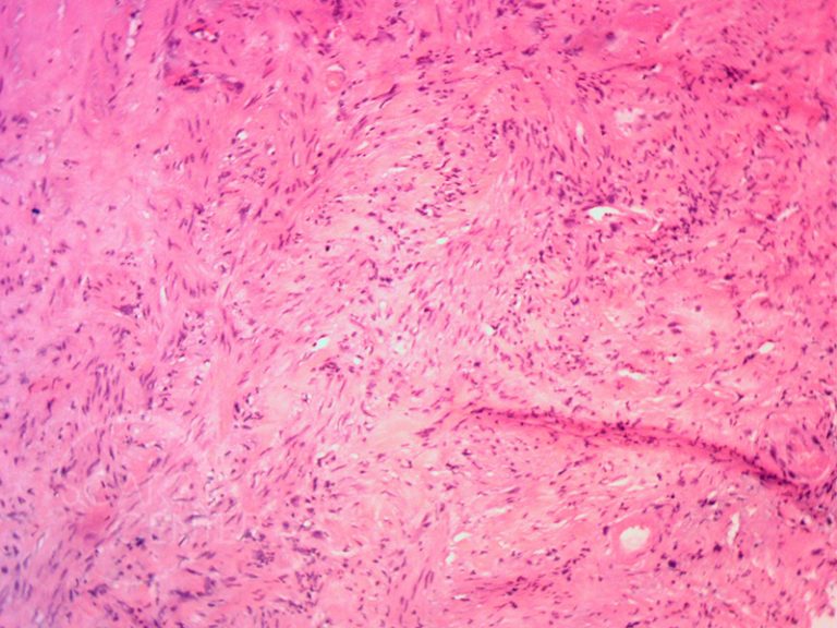 Lower Leg Radiation Ulcer - Skin Cancer and Reconstructive Surgery Center