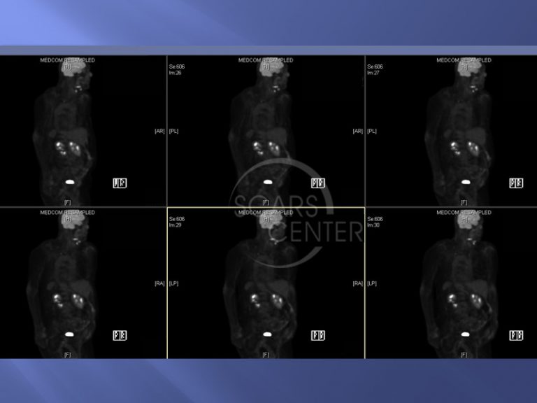 Metastatic Squamous Cell Carcinoma - Skin Cancer and Reconstructive ...
