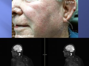 Metastatic Squamous Cell Carcinoma - Skin Cancer and Reconstructive ...