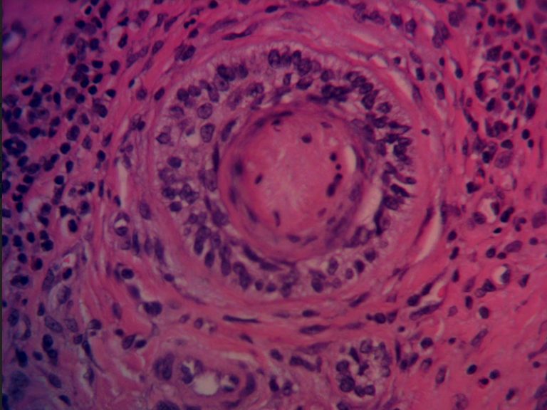 Recurrent Extensive Basal Cell Carcinoma of Forehead - Skin Cancer and ...