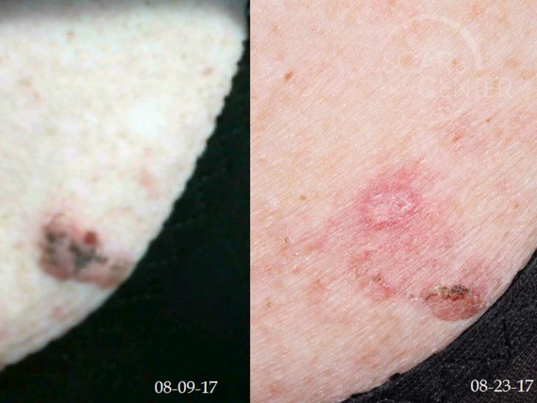 INFLAMED SK APPEARING AS SQUAMOUS CELL CARCINOMA - Skin Cancer and ...