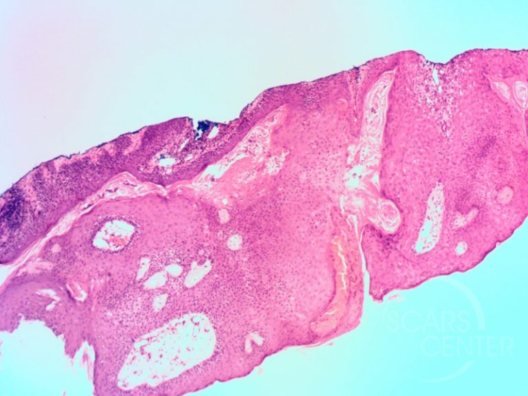 LOWER LIP ATYPIA AT MARGINS OF SQUAMOUS CELL CARCINOMA - Skin Cancer ...
