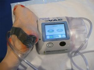 Lower Leg Radiation Ulcer - Skin Cancer and Reconstructive Surgery Center