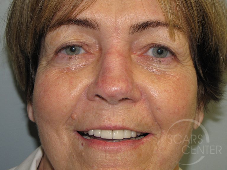 Nose Reconstruction 6 - Skin Cancer and Reconstructive Surgery Center