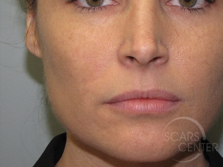 Cheek Reconstruction 2 - Skin Cancer and Reconstructive Surgery Center