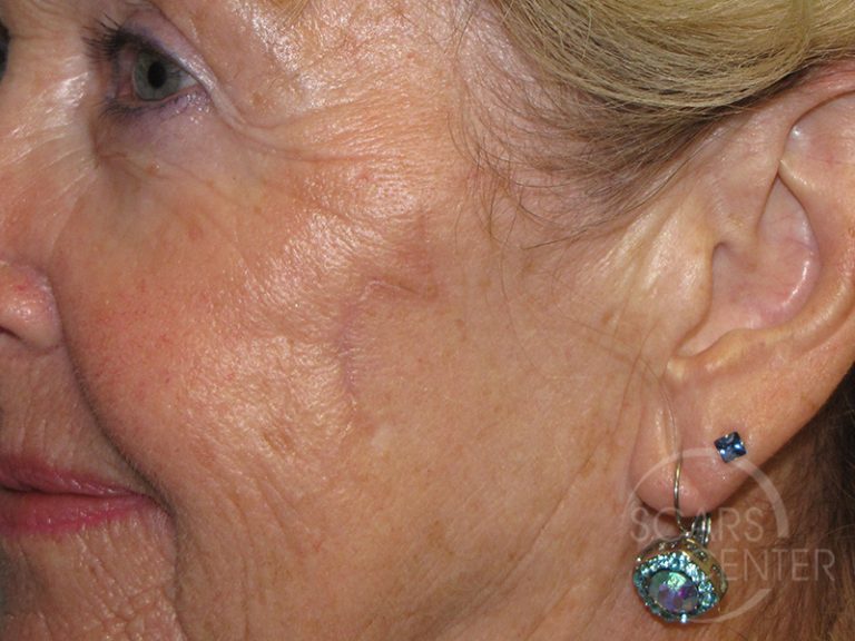 Cheek Reconstruction 1 - Skin Cancer and Reconstructive Surgery Center