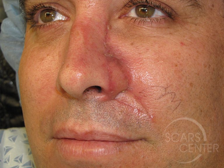 Nose Reconstruction 2 - Skin Cancer and Reconstructive Surgery Center