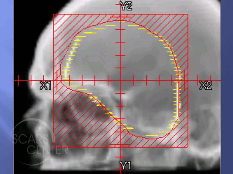 Forehead SCC with Perineural Invasion - Skin Cancer and Reconstructive ...