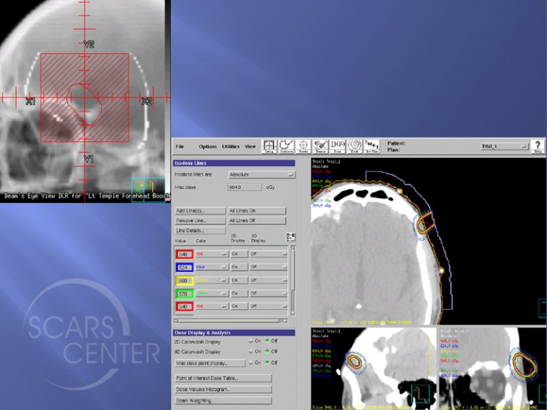 Forehead SCC with Perineural Invasion - Skin Cancer and Reconstructive ...