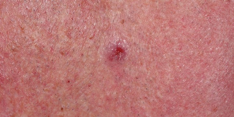 Merkle Cell Carcinoma Skin Cancer And Reconstructive Surgery Center