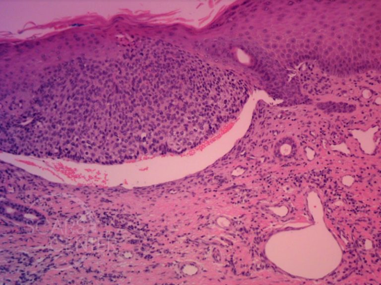 Large BCC of Thigh - Skin Cancer and Reconstructive Surgery Center