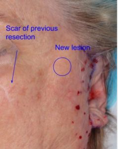 Adnexal Squamous Cell Carcinoma Recurring in Parotid - Skin Cancer and ...