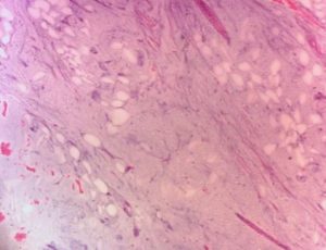 Myxoid Lipoma of Scalp - Skin Cancer and Reconstructive Surgery Center