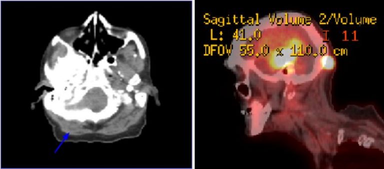 SCC of Scalp - Skin Cancer and Reconstructive Surgery Center