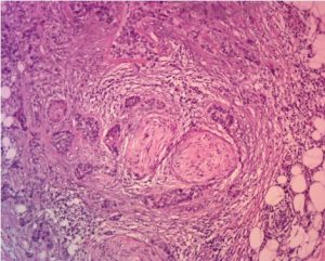Upper Chest BCC PNI - Skin Cancer and Reconstructive Surgery Center