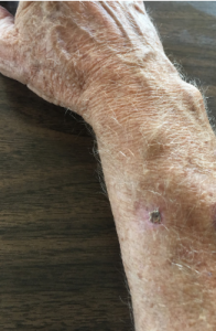 Cystic Squamous Cell Carcinoma of Forearm Skin - Skin Cancer and ...