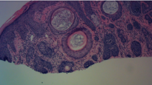 Trichoepithelioma - Skin Cancer and Reconstructive Surgery Center