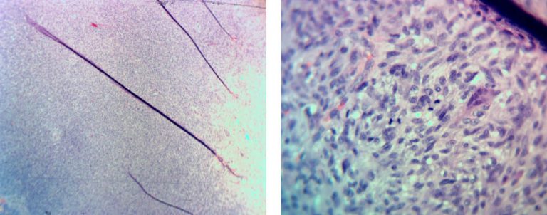 Dermatofibroma to Dermal Sarcoma: The Spectrum of Dermal Spindle Cell ...