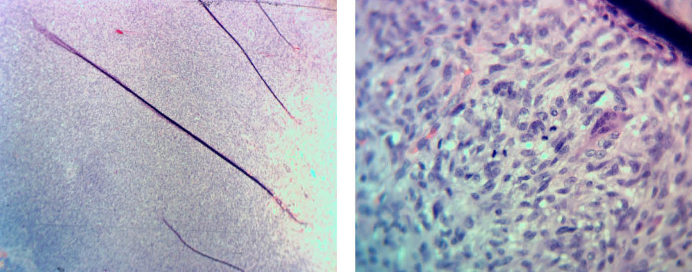Dermatofibroma to Dermal Sarcoma: The Spectrum of Dermal Spindle Cell ...