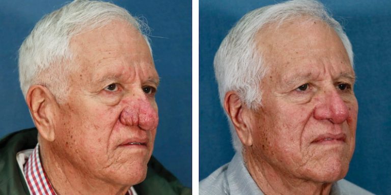 Rhinophyma Archives - Skin Cancer and Reconstructive Surgery Center