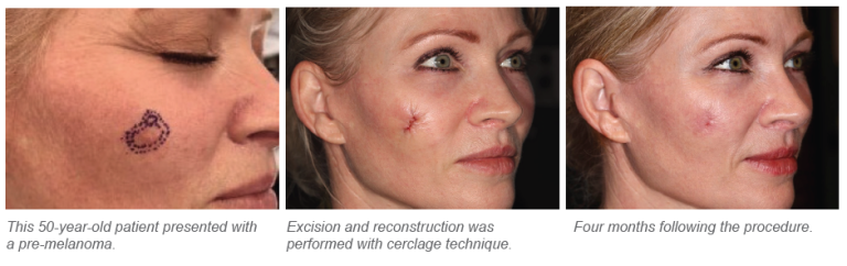 Cerclage Closure Technique - Skin Cancer and Reconstructive Surgery Center