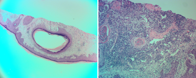 Squamous Cell Carcinoma Diagnosis | Skin Cancer And Reconstructive ...