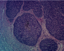 Atypical Fibroxanthoma – AFX | Skin Cancer And Reconstructive Surgery ...